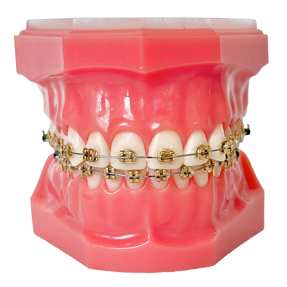 Braces In Castro Valley - Kids, Teens, & Adults